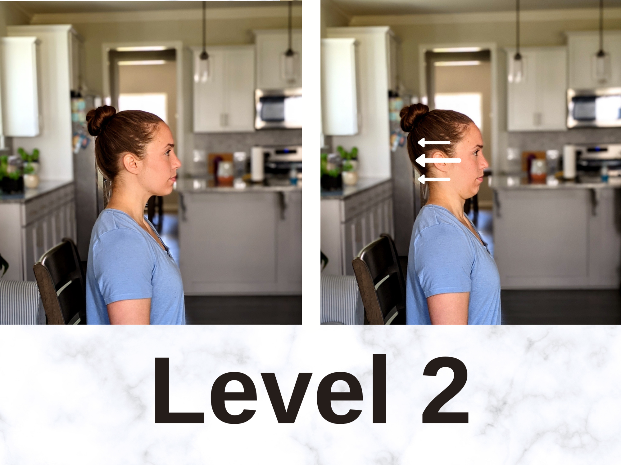 The Authoritative Guide to Cervical Radiculopathy (and 8 Effective ...