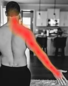 The Authoritative Guide to Cervical Radiculopathy (and 8 Effective ...